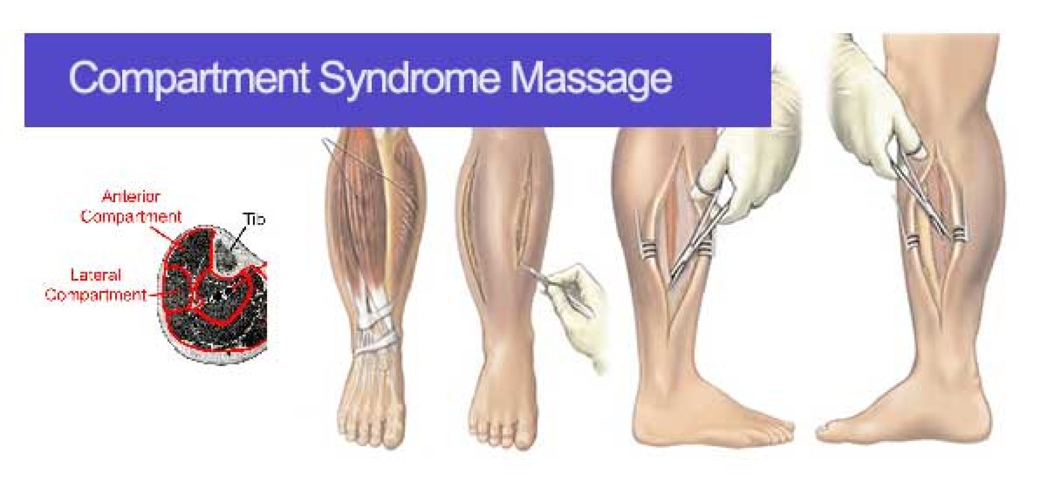 Compartment Syndrome Massage Treatment
