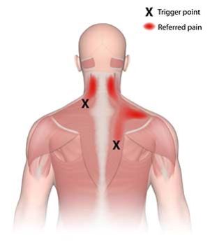 TRIGGER POINTS: What Are They, Causes, Effects, Symptoms