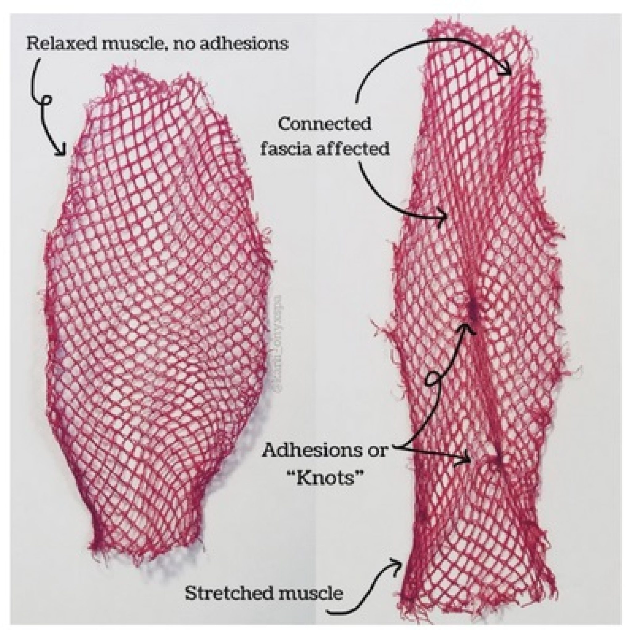 What Are Adhesions? | Medical Massage Therapy