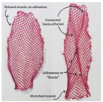 What Are Adhesions? | Medical Massage Therapy