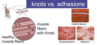 Knots vs. Adhesions - What's the Difference?
